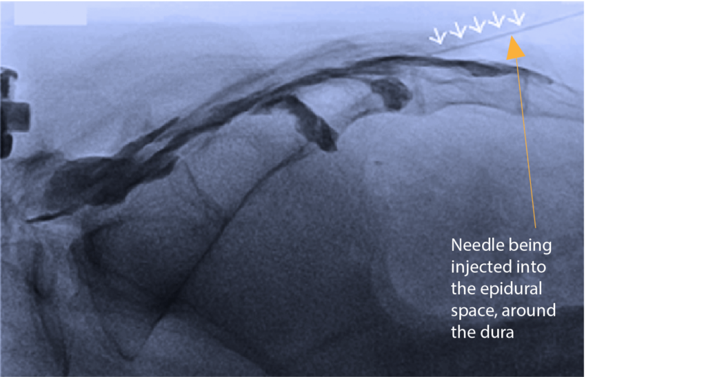 Caudal Epidural Injections - Rajiv Bajekal