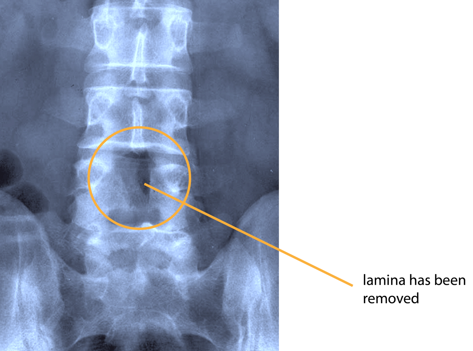 Lumbar Decompression (Laminectomy) - Rajiv Bajekal