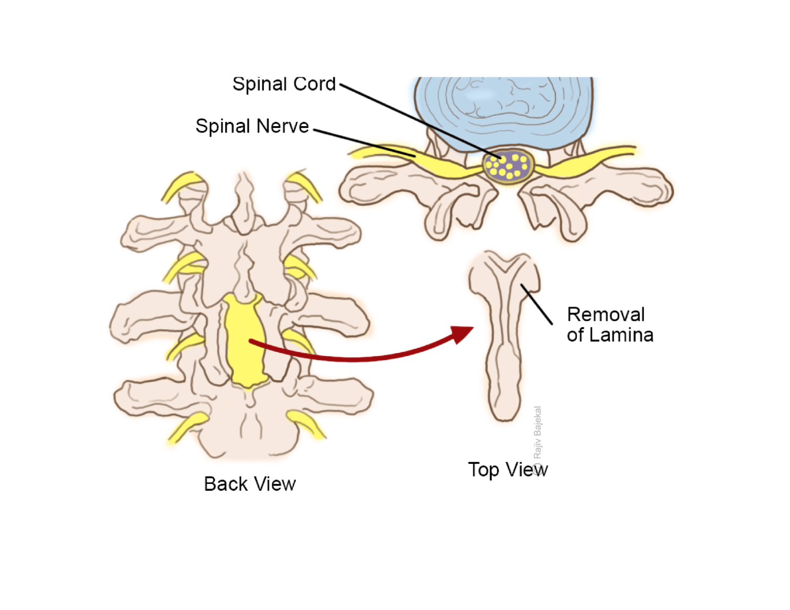 Lumbar Decompression (Laminectomy) - Rajiv Bajekal